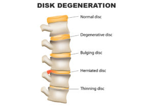 Herniated Disc C4/C5 and C5/C6 Injuries - Fort Worth, TX - Stephens Law ...